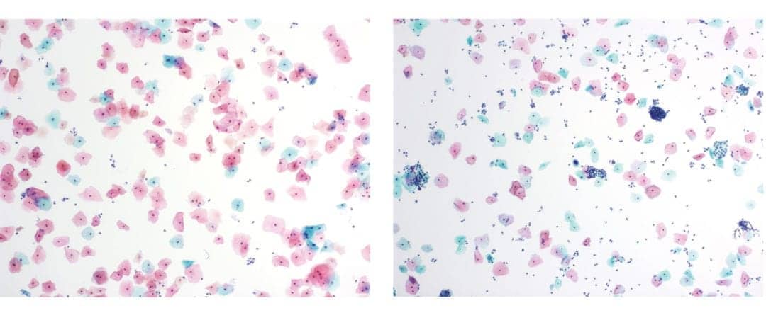 Screening for Cervical Cancer | Clinical Lab Products