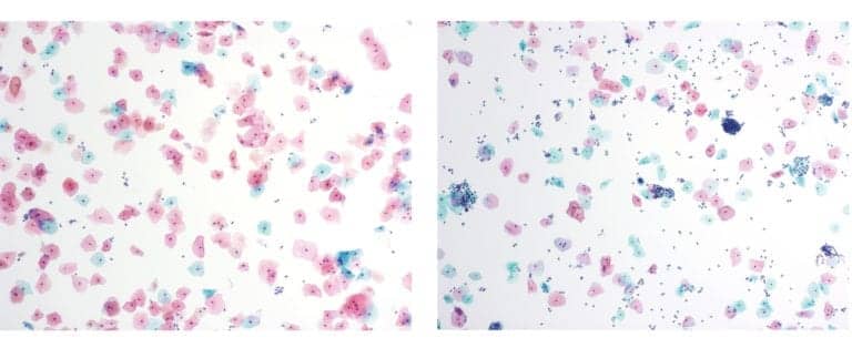 Screening for Cervical Cancer | Clinical Lab Products