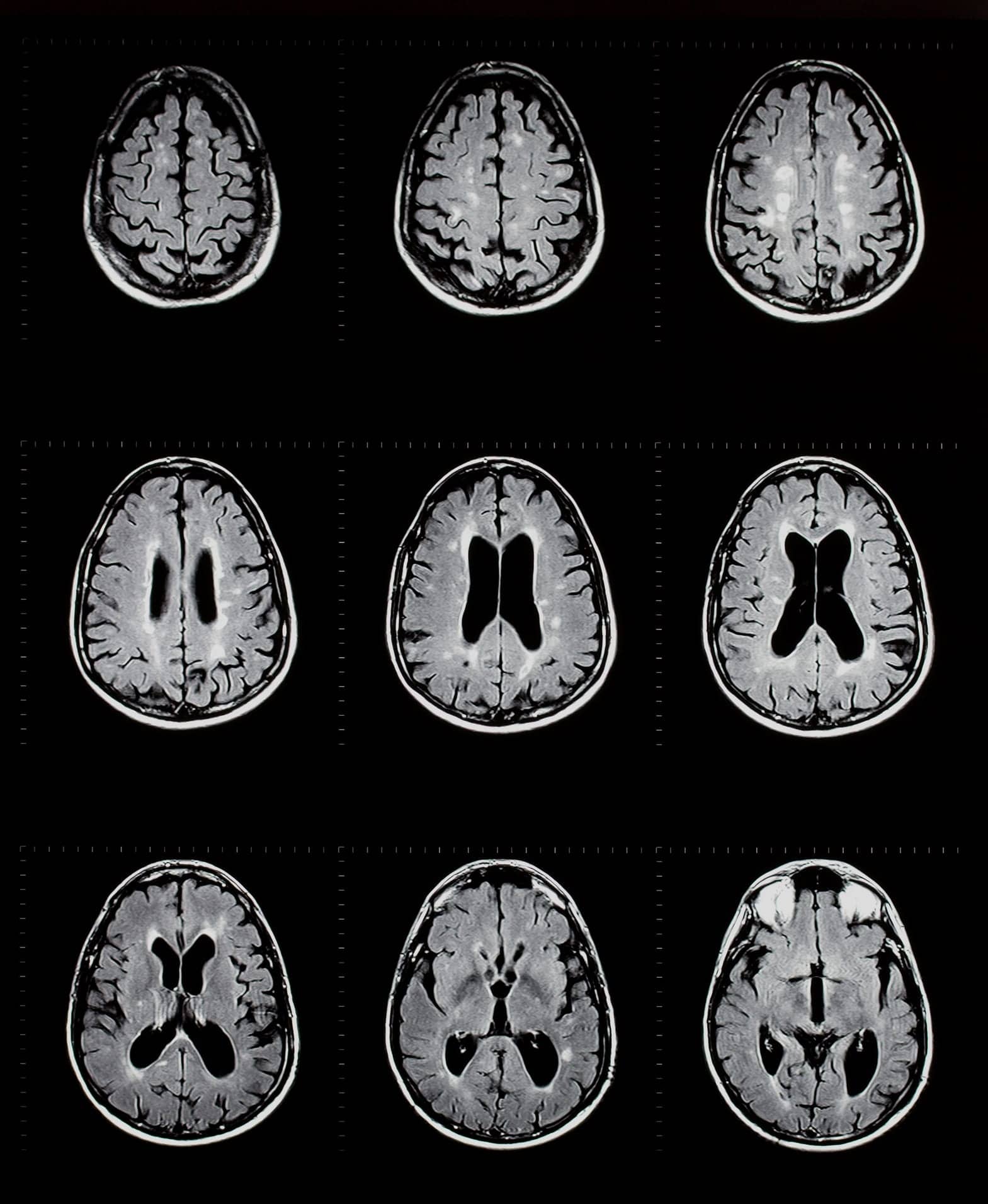 Multiple Sclerosis Mechanism - Clinical Lab Products
