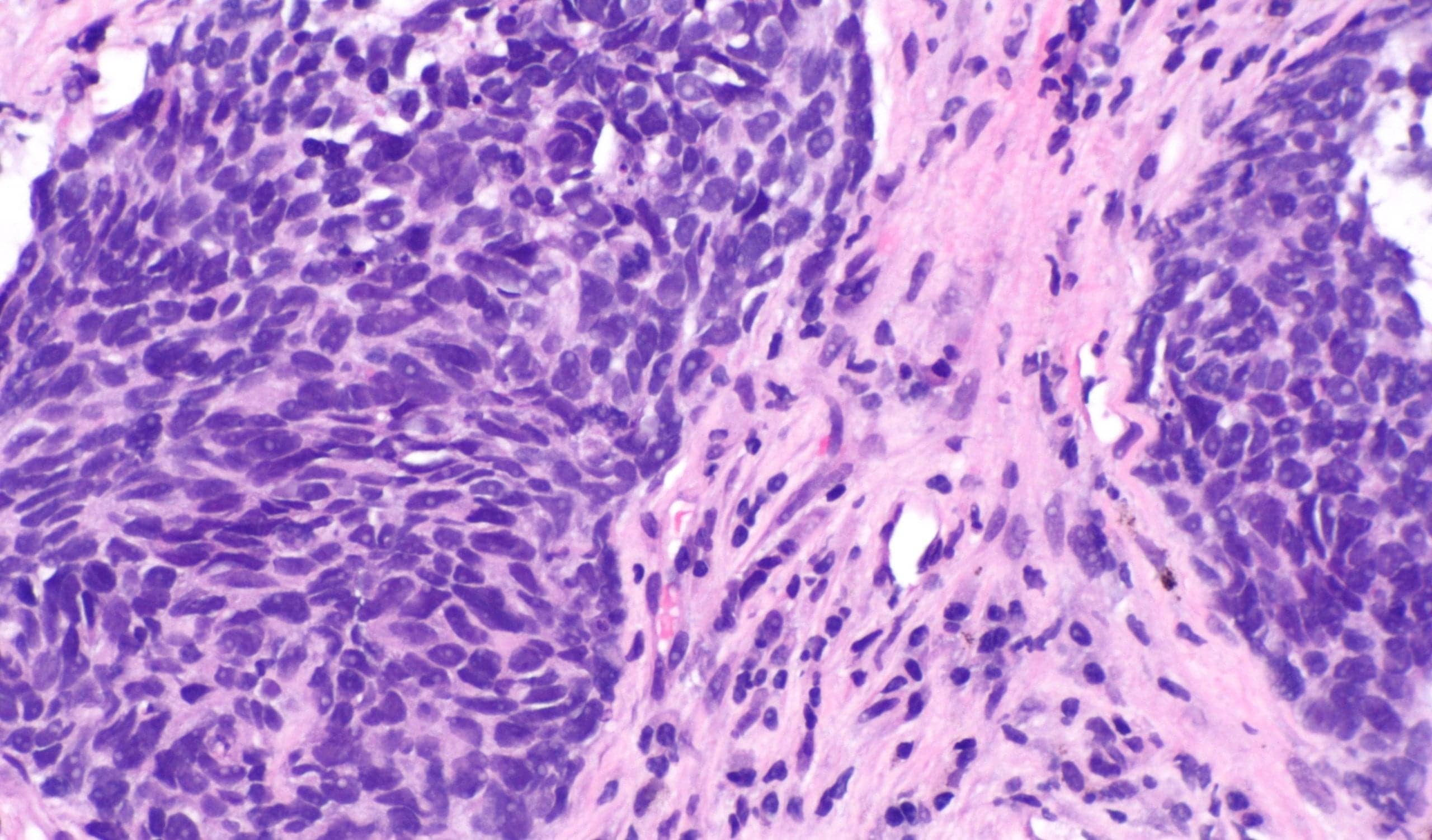 metastatic non-small cell lung cancer - Clinical Lab Products