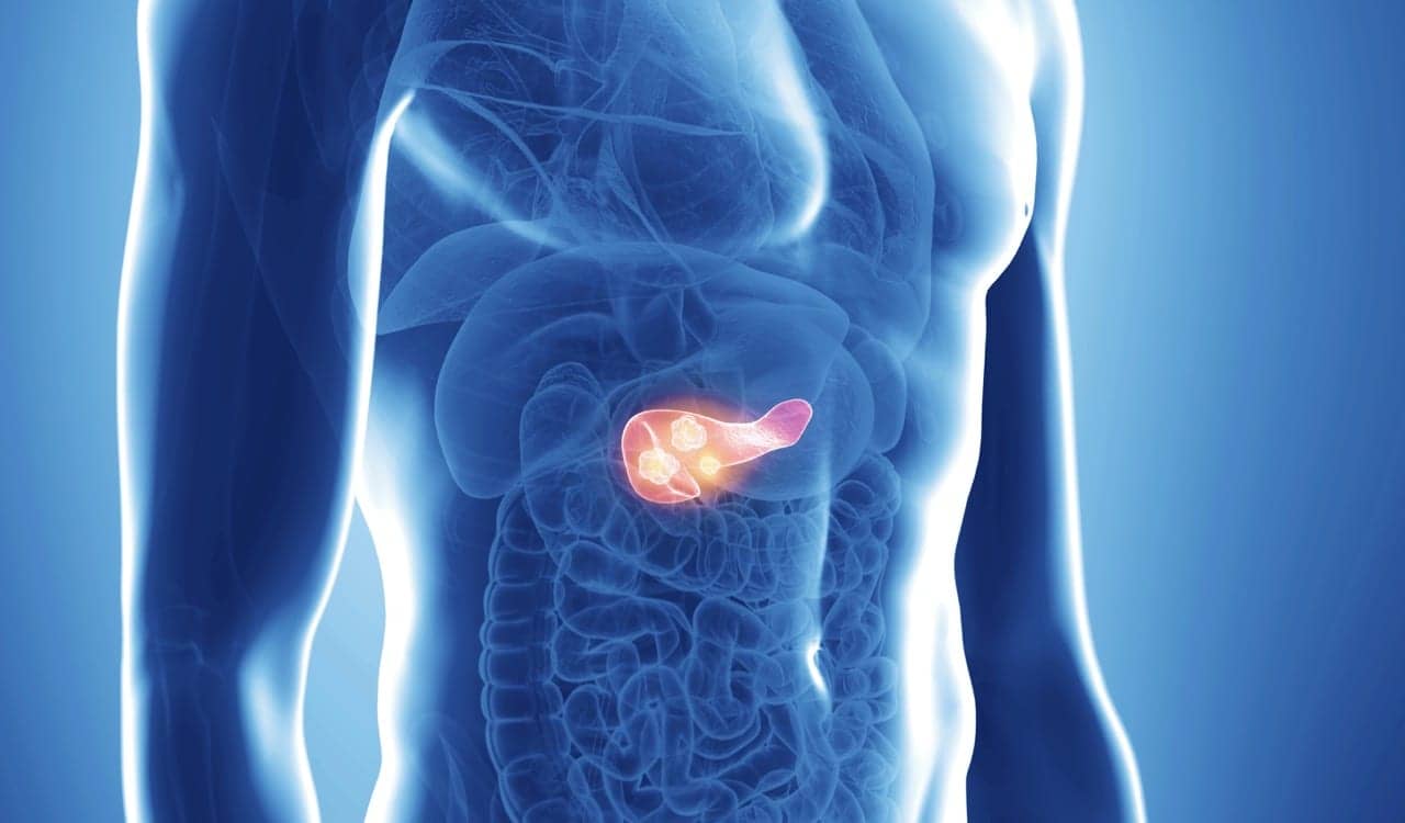 Sysmex Inostics' Liquid Biopsy Testing Aids Pancreatic Cancer Management