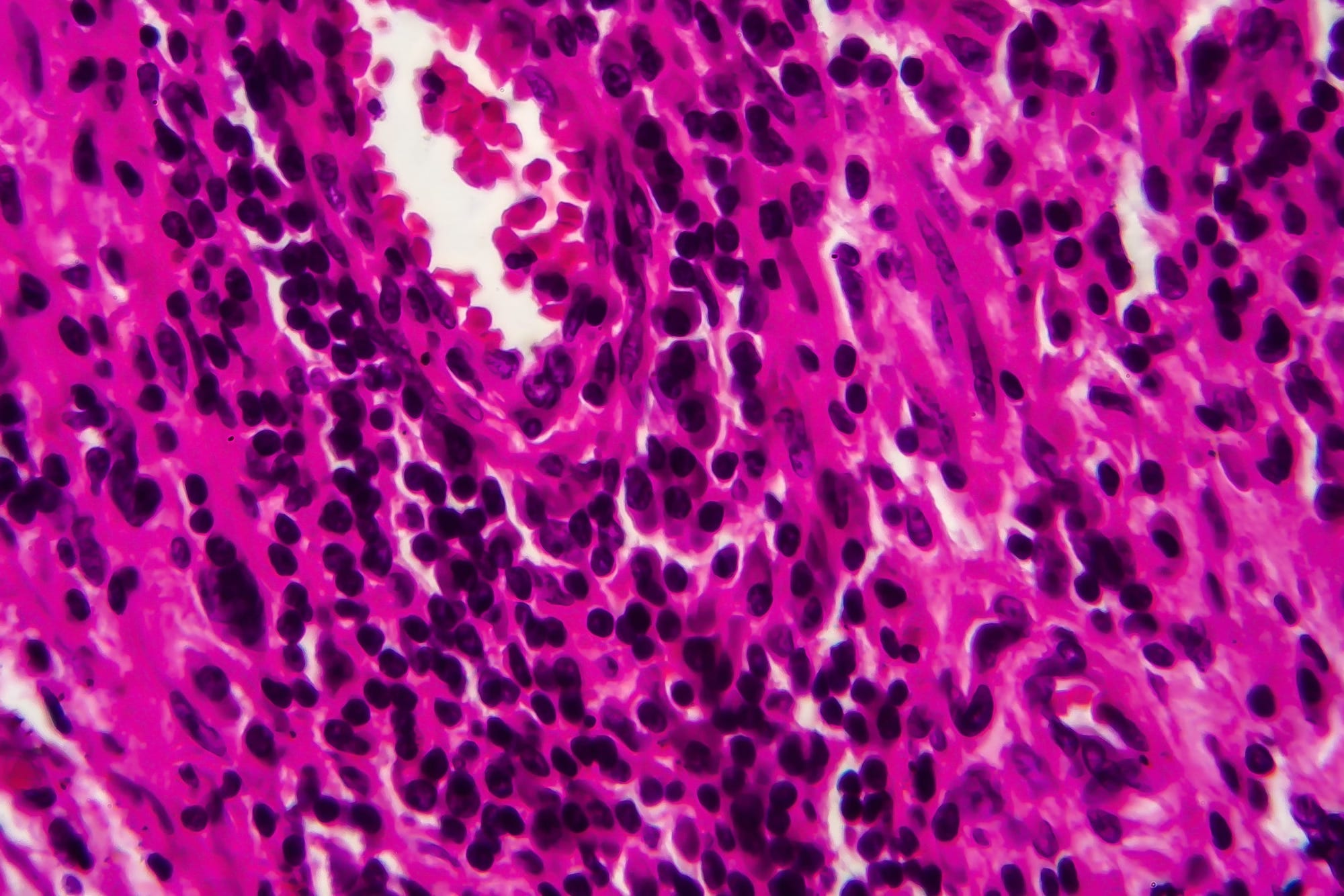 Novel Urine Screening Test Can Detect New and Recurrent Bladder Cancer ...