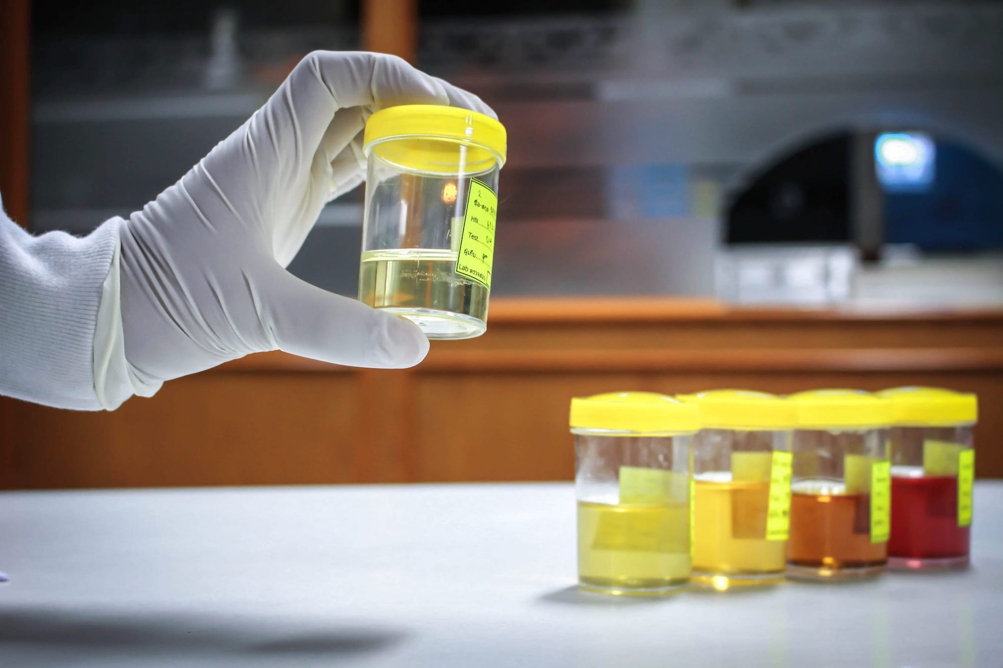 AnchorDx UriFind Bladder Cancer Test Gets FDA Breakthrough Device AnchorDx UriFind Bladder Cancer Test Gets FDA Breakthrough Device