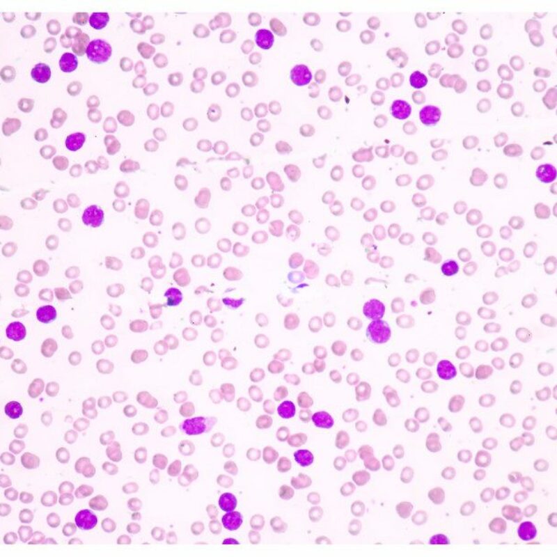 Acute Lymphocytic Leukemia Cells Acute Lymphoblastic Leukaemia The