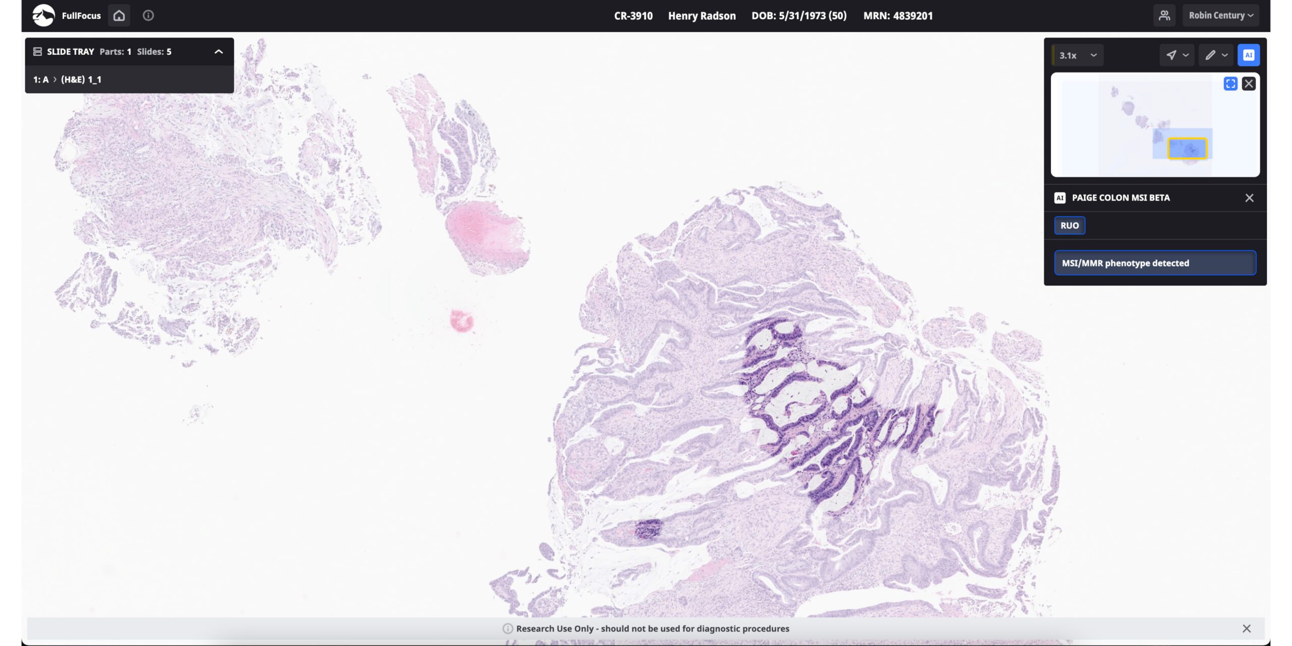 New Colon MSI AI-Based Digital Assay Reduces Diagnostic TAT | Clinical ...