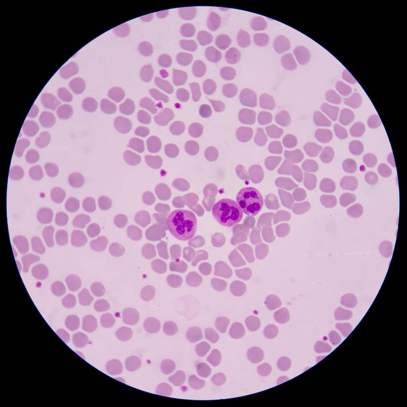 Sepsis Diagnosis Gets Point-of-Care Solution | Clinical Lab Products