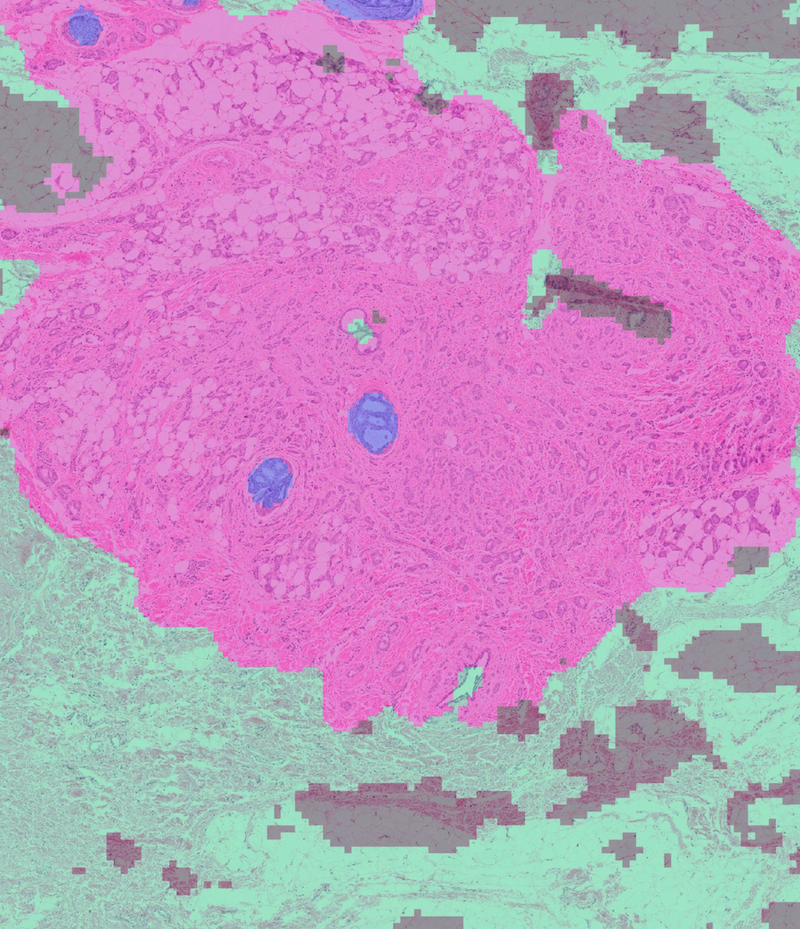 Digital Morphology Solution Predicts Breast Cancer Recurrence Clinical Lab Products