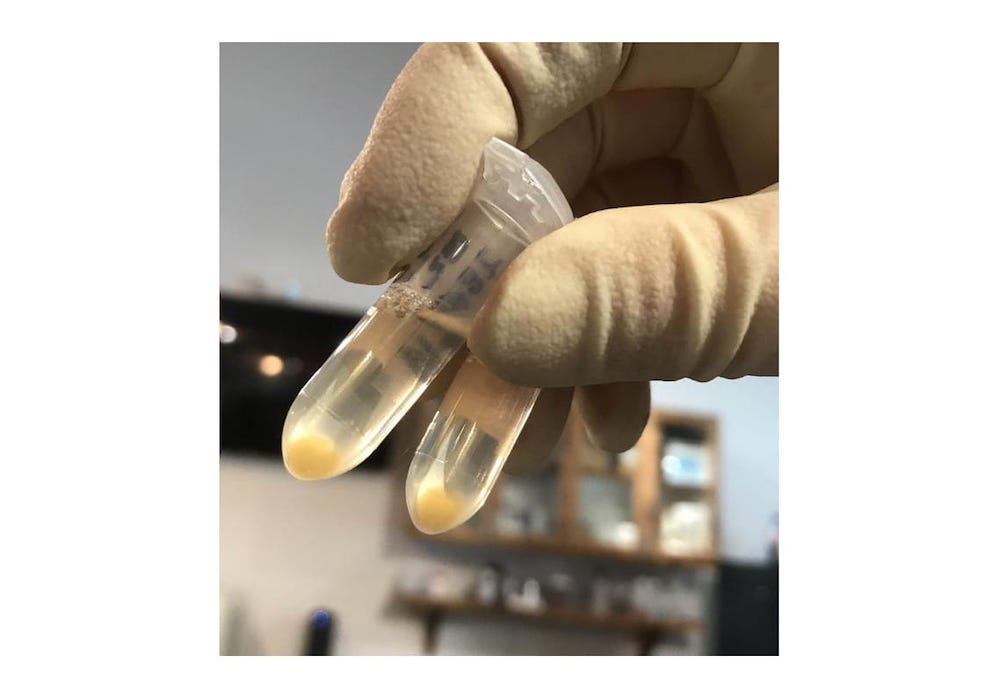 New Blood Test for ALS Offers 98% Accuracy and Faster Diagnoses ...