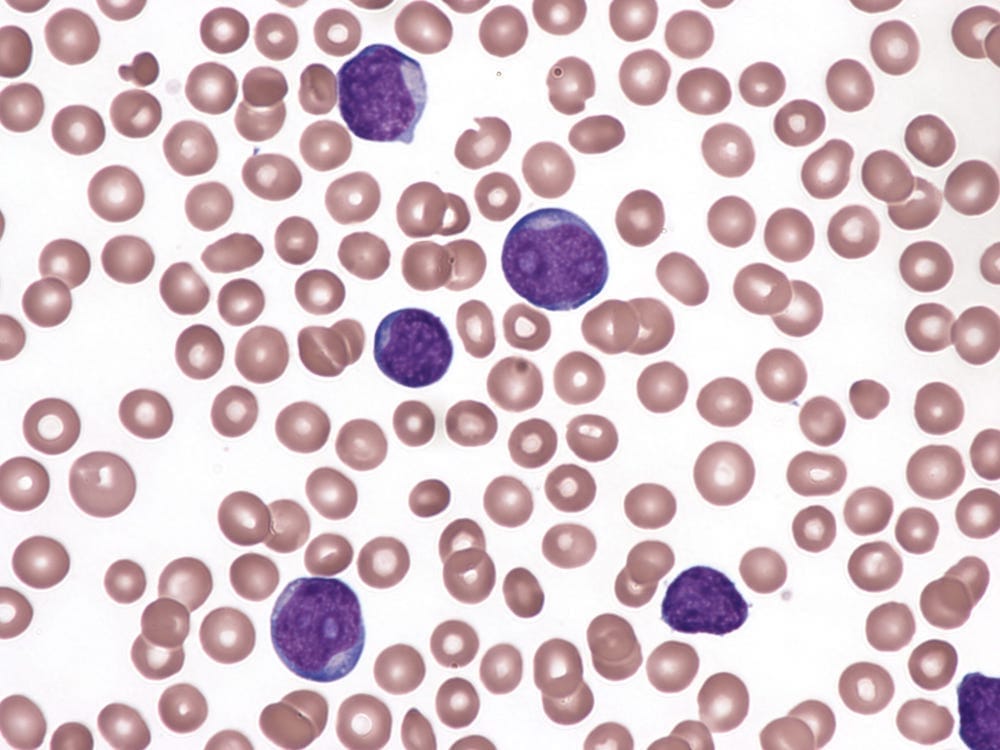 NCCN Guidelines Add ctDNA-MRD Testing Recommendation for B-Cell ...