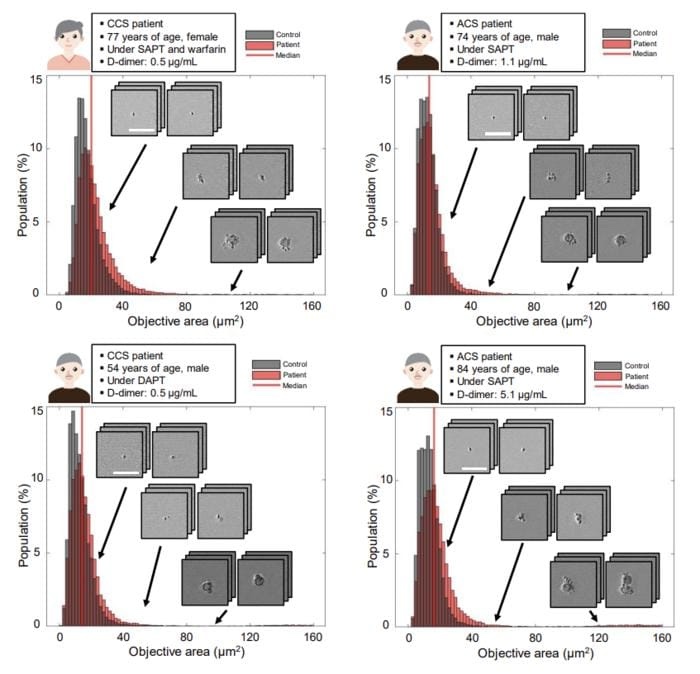 Platelet Clumping Monitoring May Open Door to Personalized Treatment ...