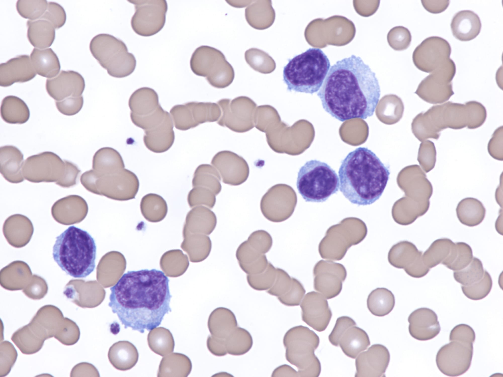Ultrasensitive MRD Test Shows Greater Prognostic Accuracy Than PET/CT ...
