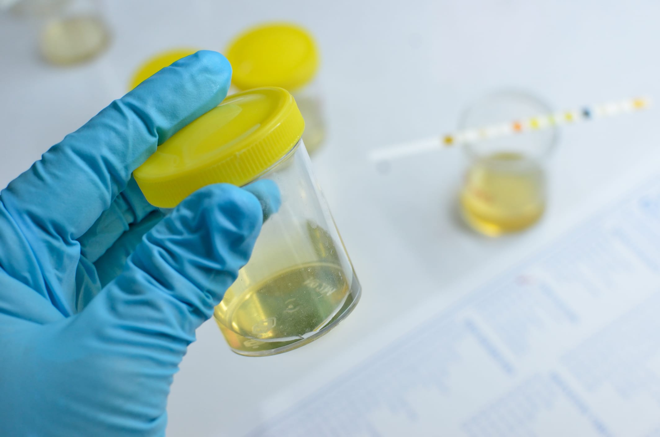 Yenos Analytical Launches Multi-Cancer Early Detection Urine Test ...