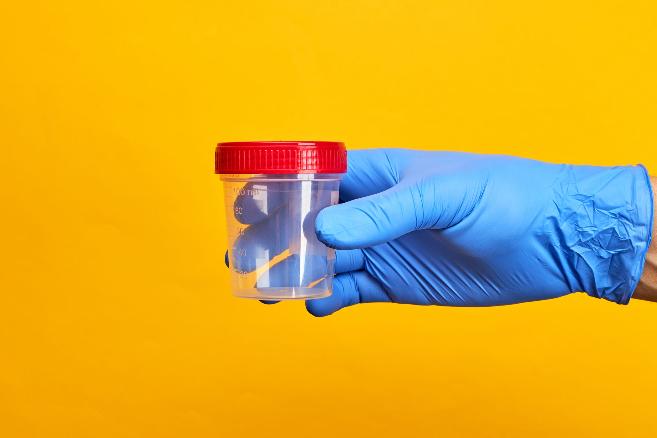 Urine Test Can Diagnose Bladder Cancer, Study Shows | Clinical Lab Products
