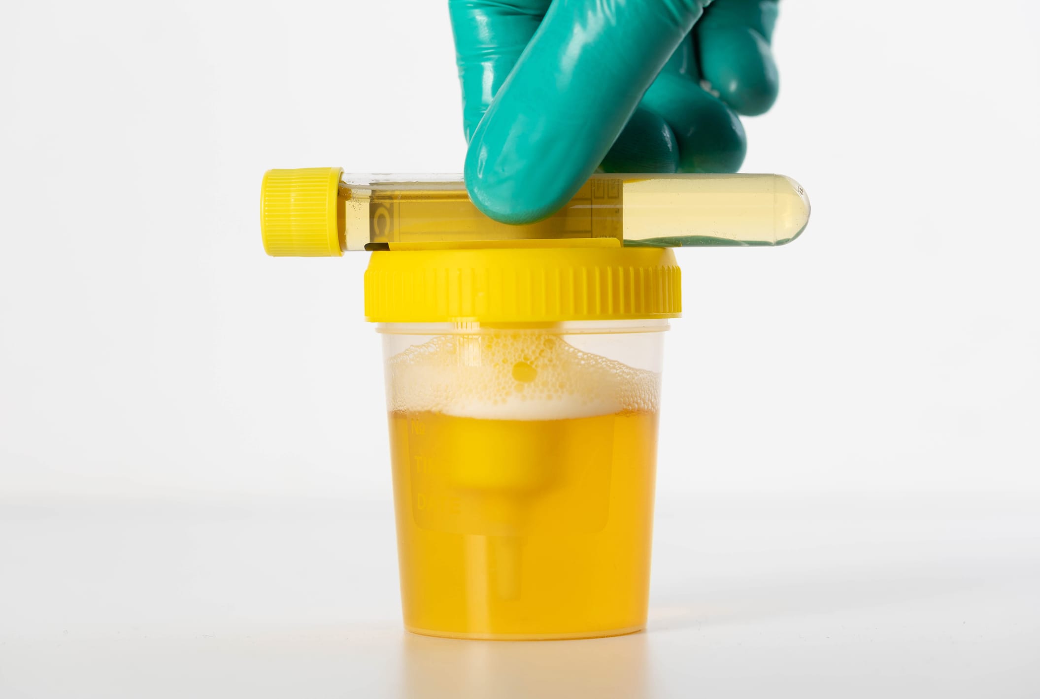 EpiCapture Urine-Based Prostate Cancer Test Shows High Accuracy in ...