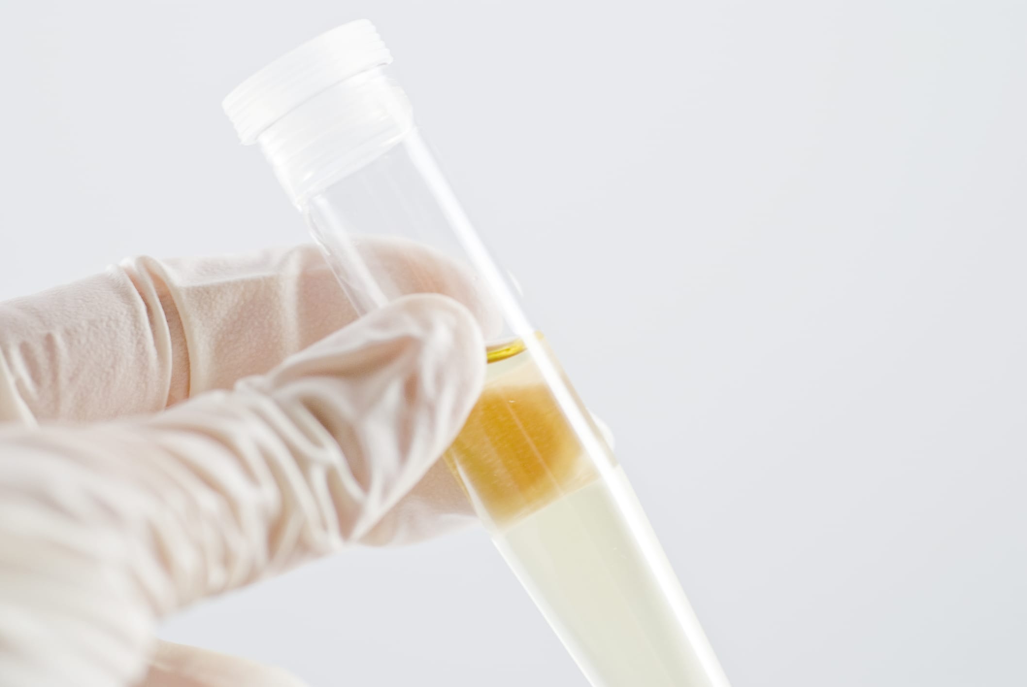 FDA Grants Breakthrough Designation to Urine-Based Alzheimer’s Test ...